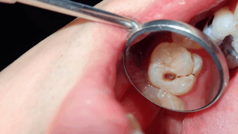 What Does A Cavity Look Like? How To Know If You Have One And What to ...